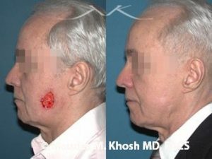 New York Cheek Reconstruction Facial Plastic Surgeon | Manhattan