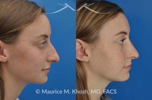 NYC Droopy Tip Nose Correction Surgery | New York Hooked Nose Rhinoplasty