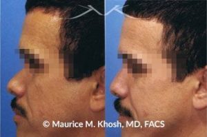New York Nose Reconstruction Facial Plastic Surgeon | Manhattan