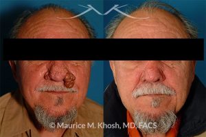 New York Rhinophyma Treatment | Maurice M. Khosh MD, FACS