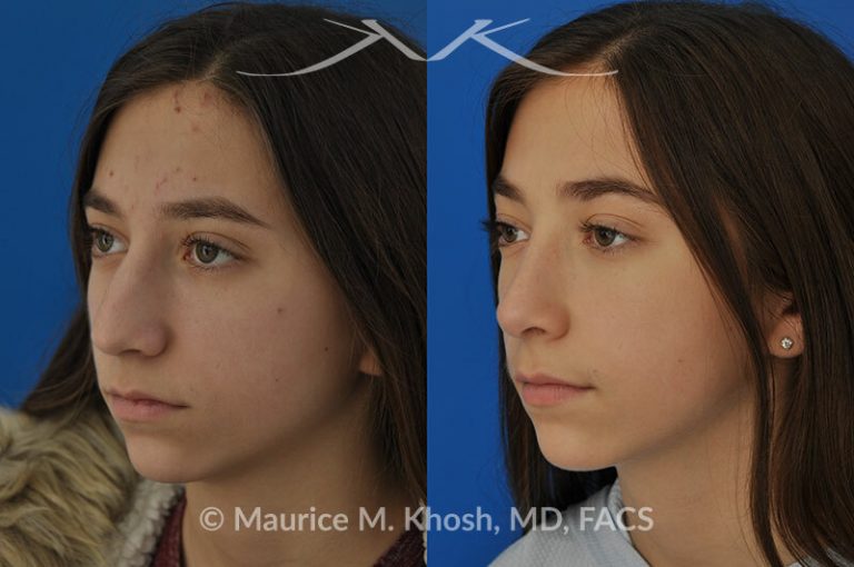 NYC Rhinoplasty | New York Nose Job Surgery | Manhattan