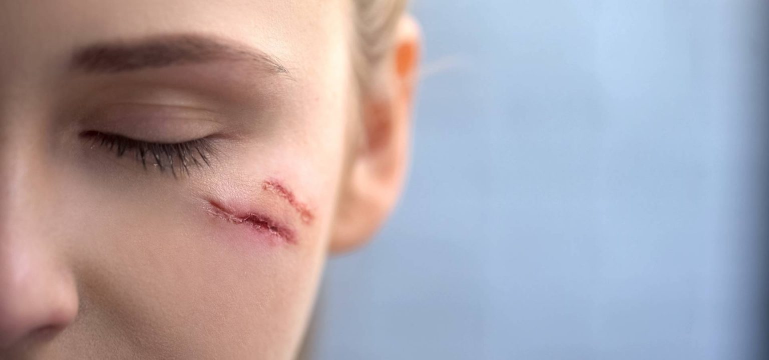 New York Burn Scar Treatment | Maurice M. Khosh MD, FACS